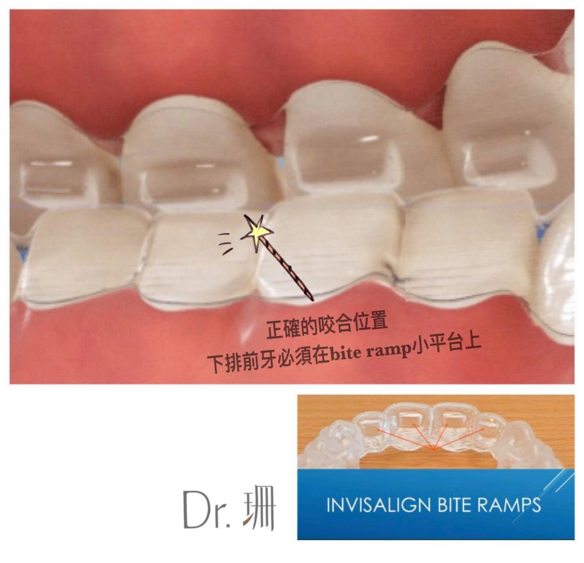 專為矯正深咬設計的隱適美【bite ramp】，輕鬆達到咬合調整- Dr.珊