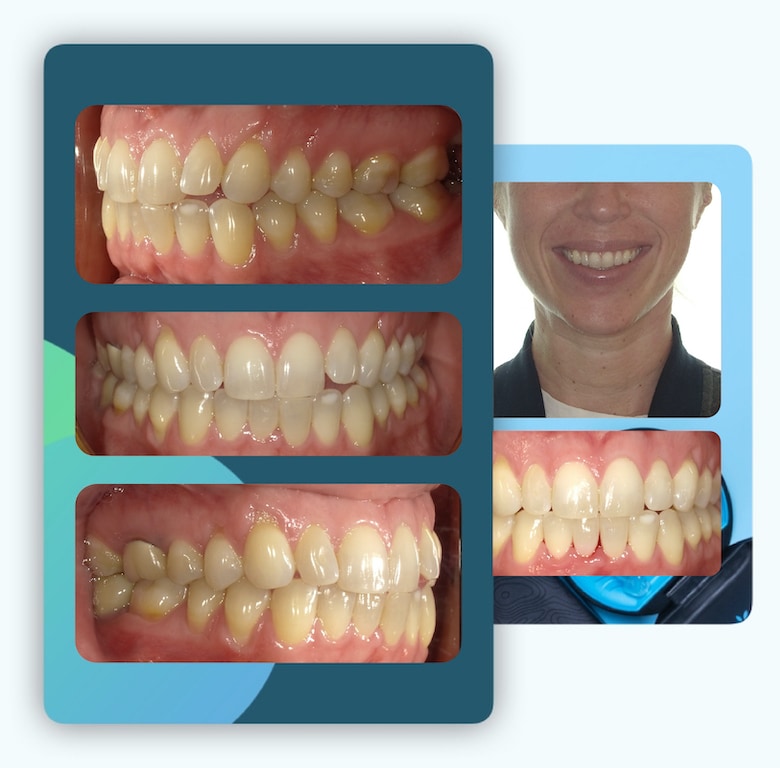 隱適美Lite 輕矯正 Invisalign Lite Cases - Dr.珊｜台中推薦牙醫