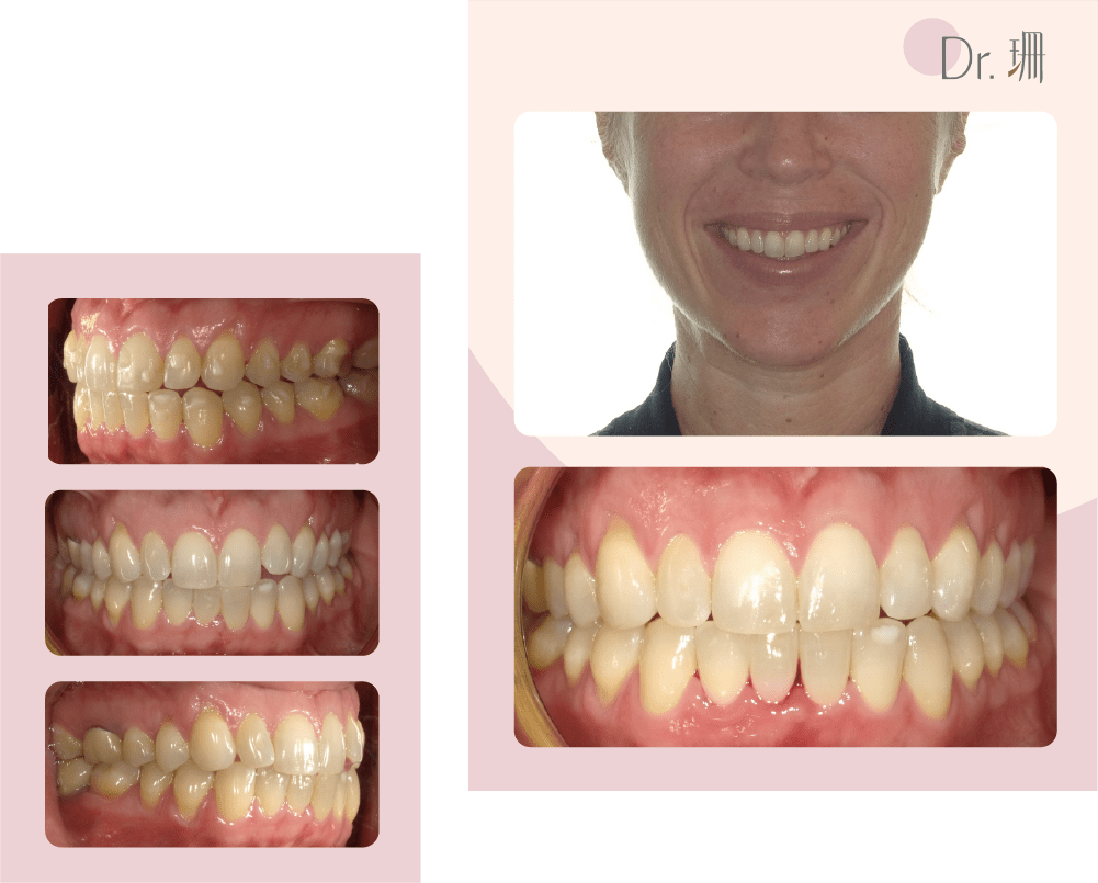 隱適美Lite 輕矯正 Invisalign Lite Cases - Dr.珊｜台中推薦牙醫